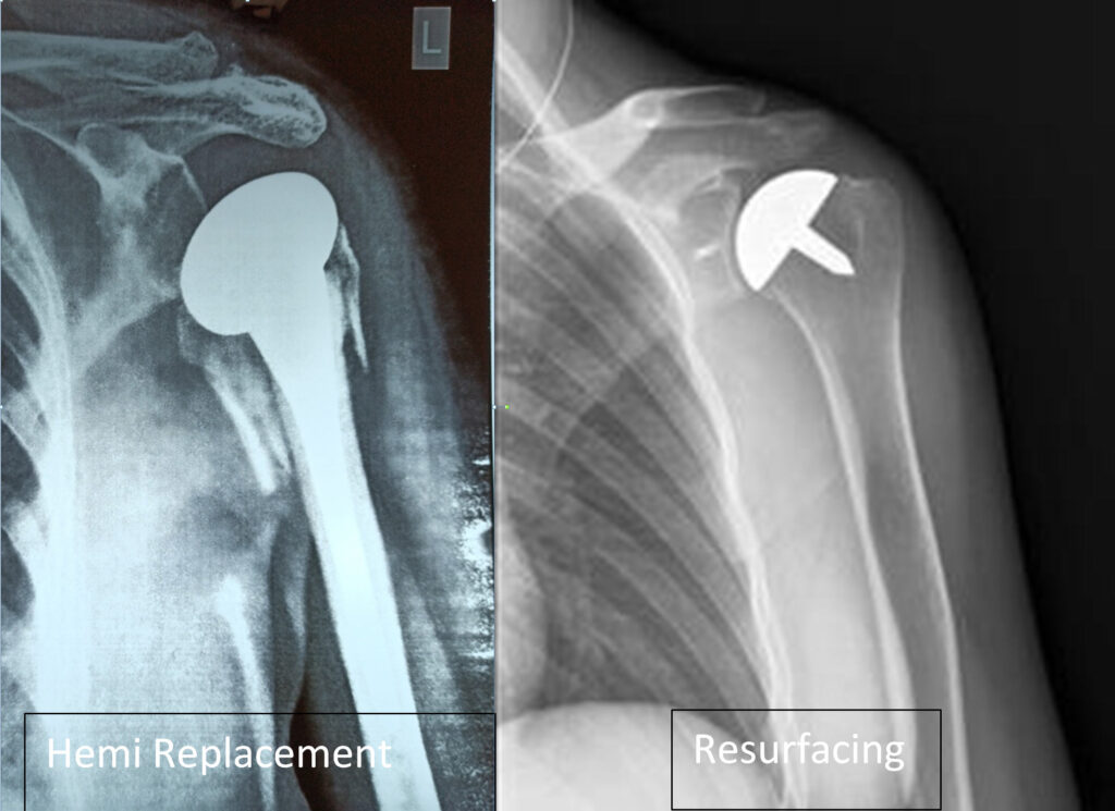 Shoulder Replacement in Aurangabad | Advanced Joint Surgery