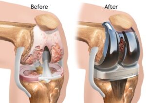 Shoulder Replacement in Aurangabad | Advanced Joint Surgery