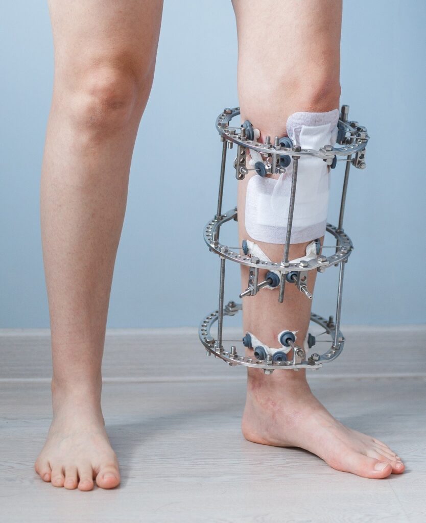 Ilizarov Surgery in Aurangabad